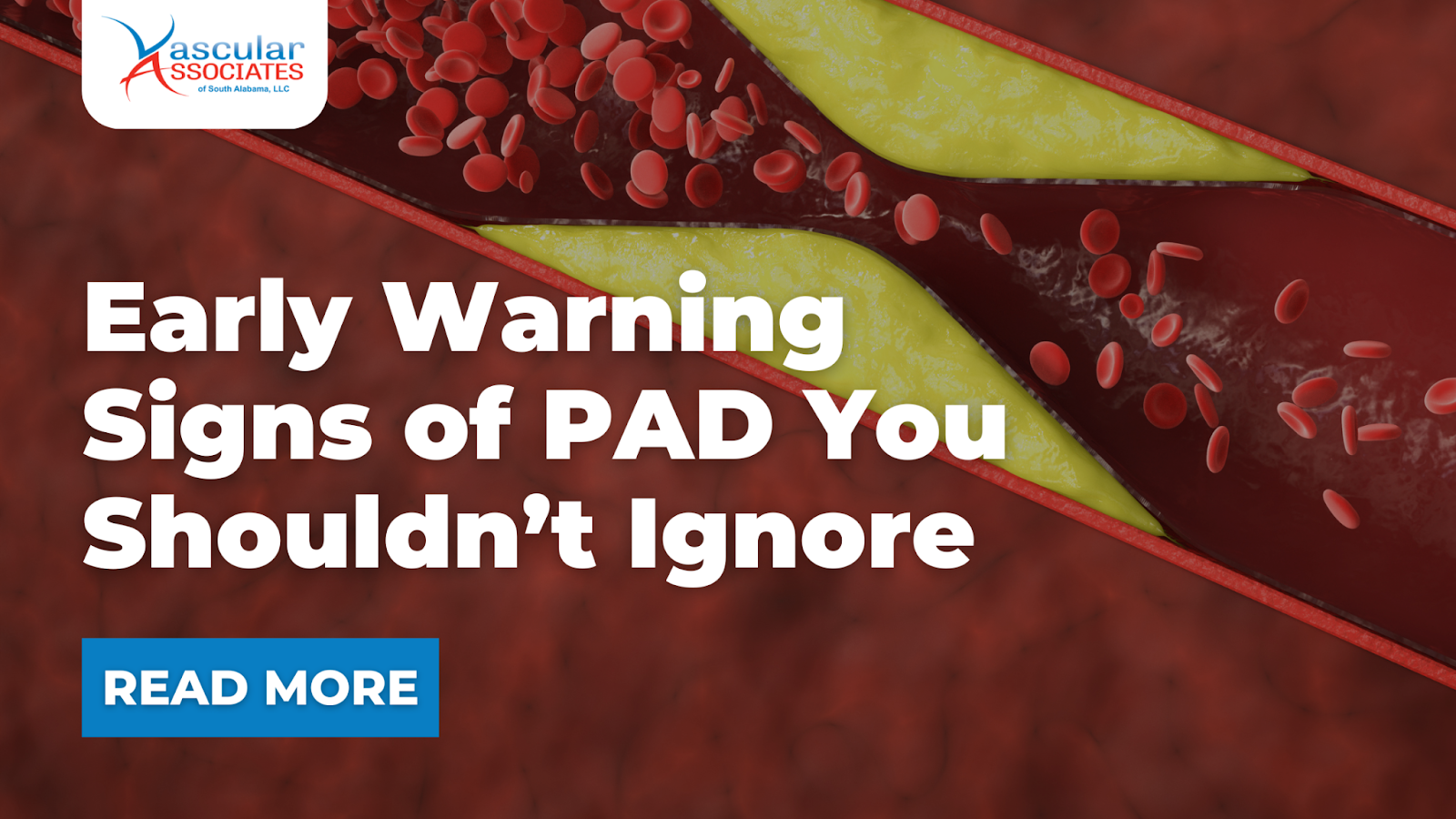 Vascular Associates Blog | Early Warning Signs of PAD You Shouldn