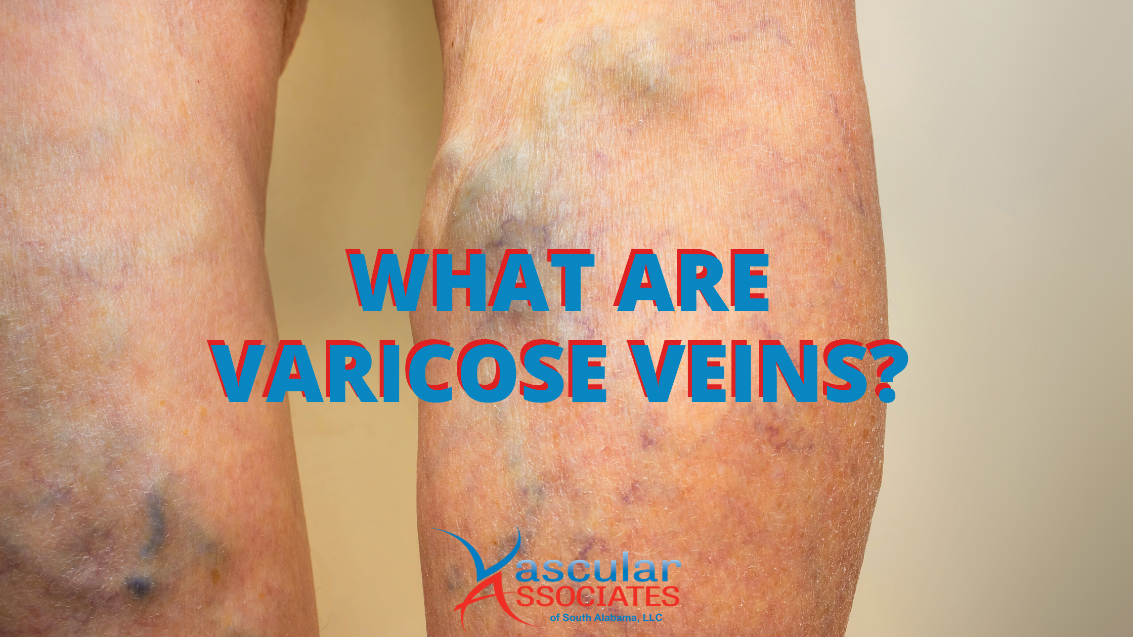 Vascular Associates Blog | What are Varicose Veins?